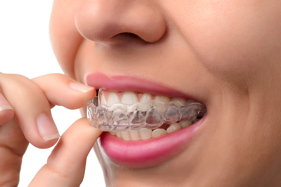 Reasons to Get Invisalign (Besides Straighter Teeth) Lewes DE | The ...